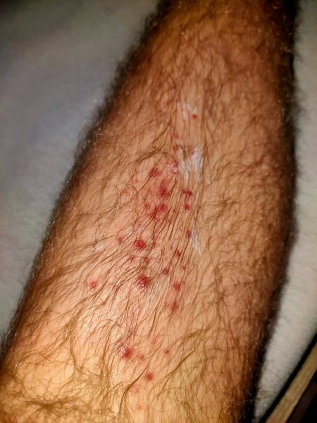 Červené vyrážky na ruke a na lýtku - Modrý koník