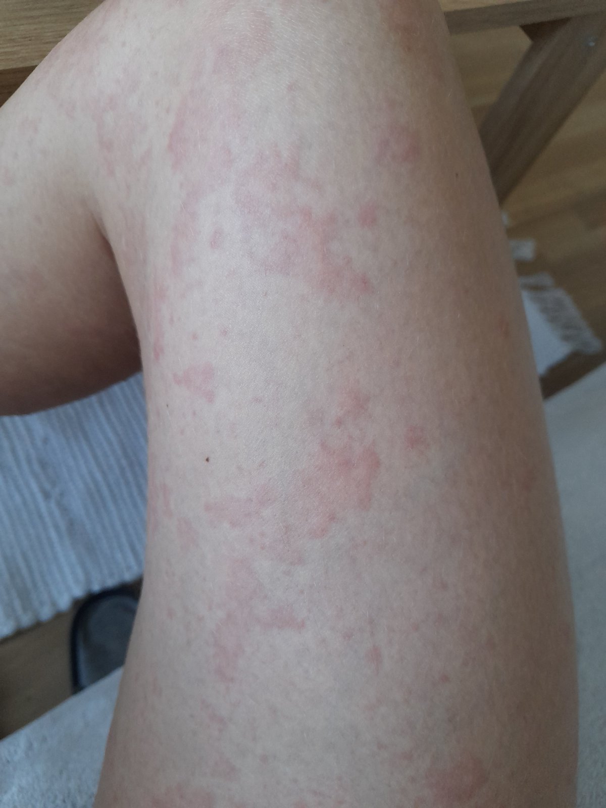 Výsyp - vyrážky na stehnách - Modrý koník