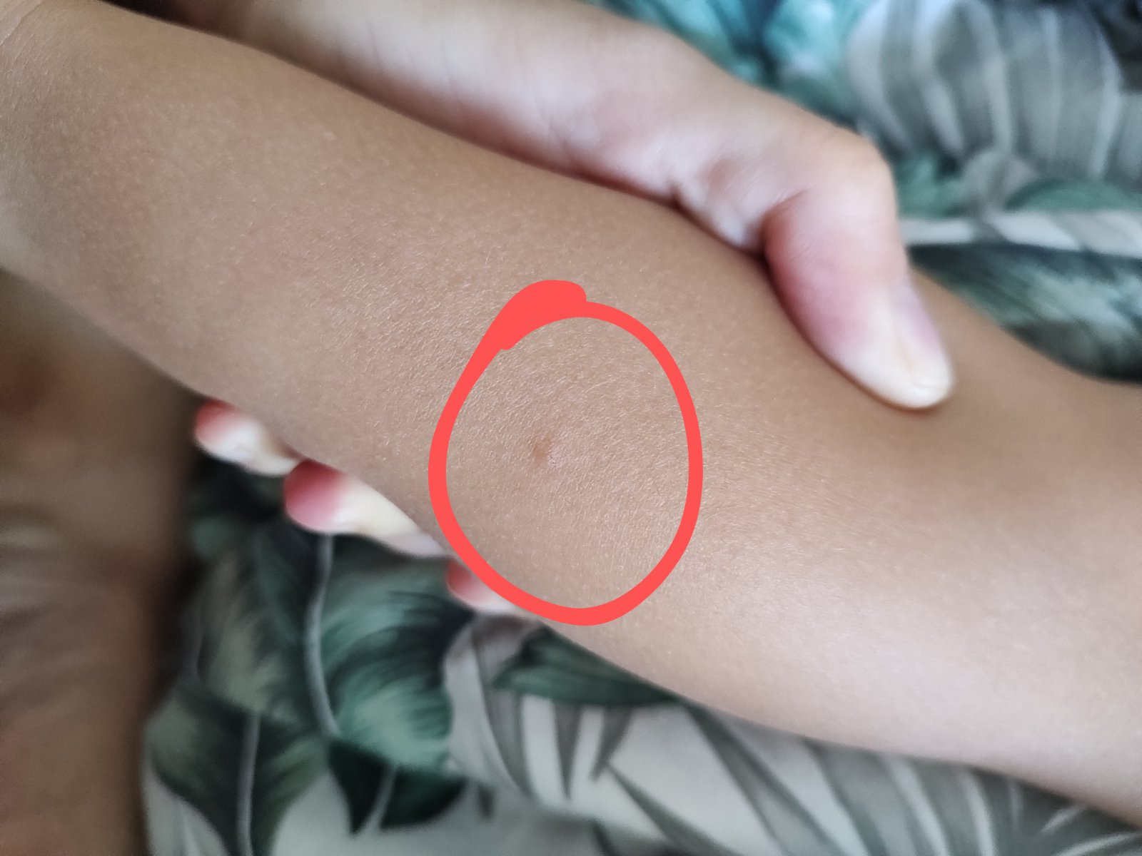 [Zodpovedané] Má môj syn kiahne alebo výsyp z kúpania? - Modrý koník