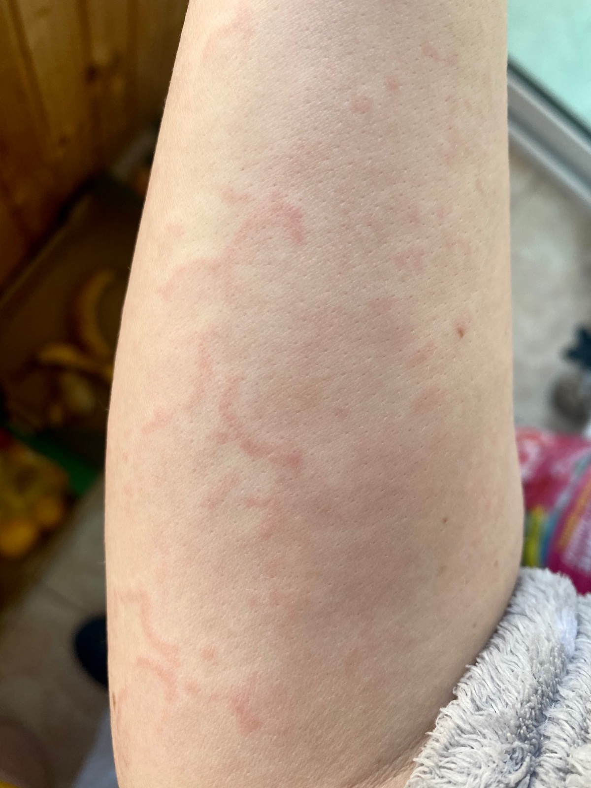 Červené fľaky na rukách - Modrý koník