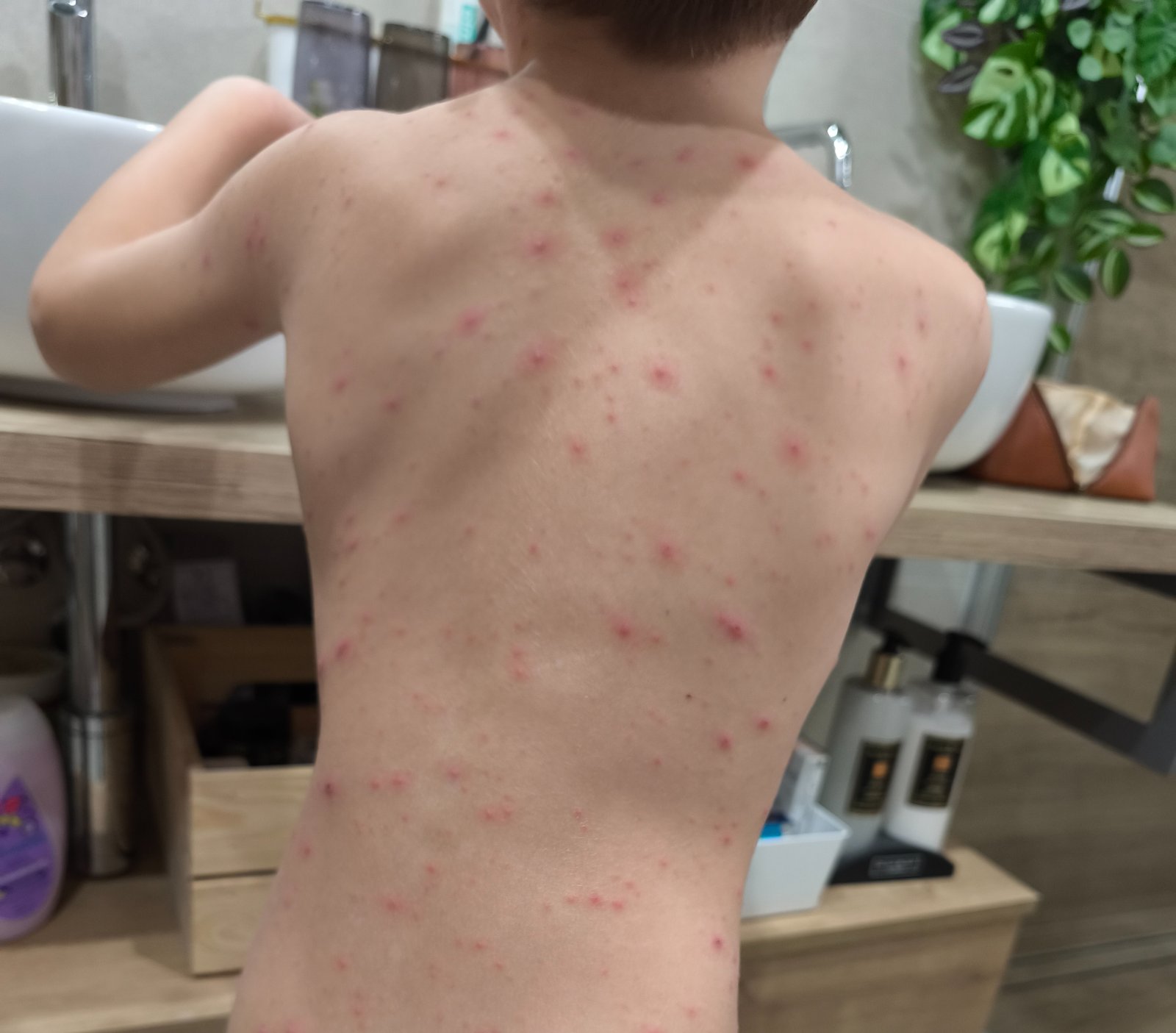 Samoliečba kiahní: -Fenistil a hypermangán - Modrý koník