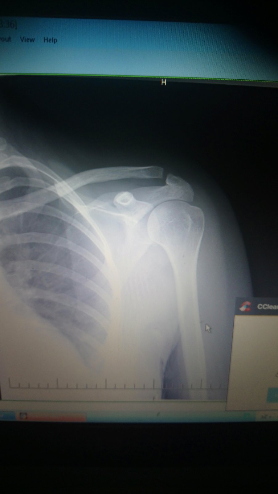 [Zodpovedané] Mám vykĺbené a bolestivé rameno. Aký je Váš názor na RTG ...