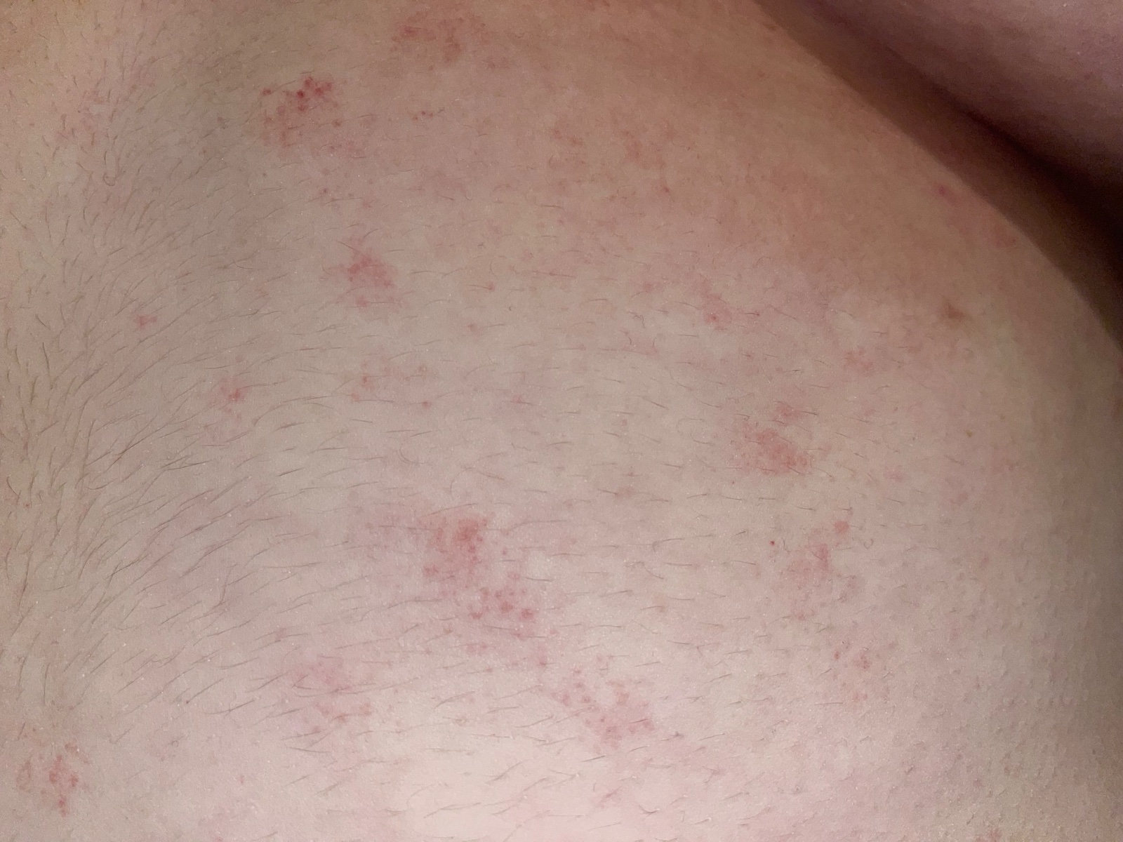 Vyrážky na bruchu a pod prsiami - Modrý koník