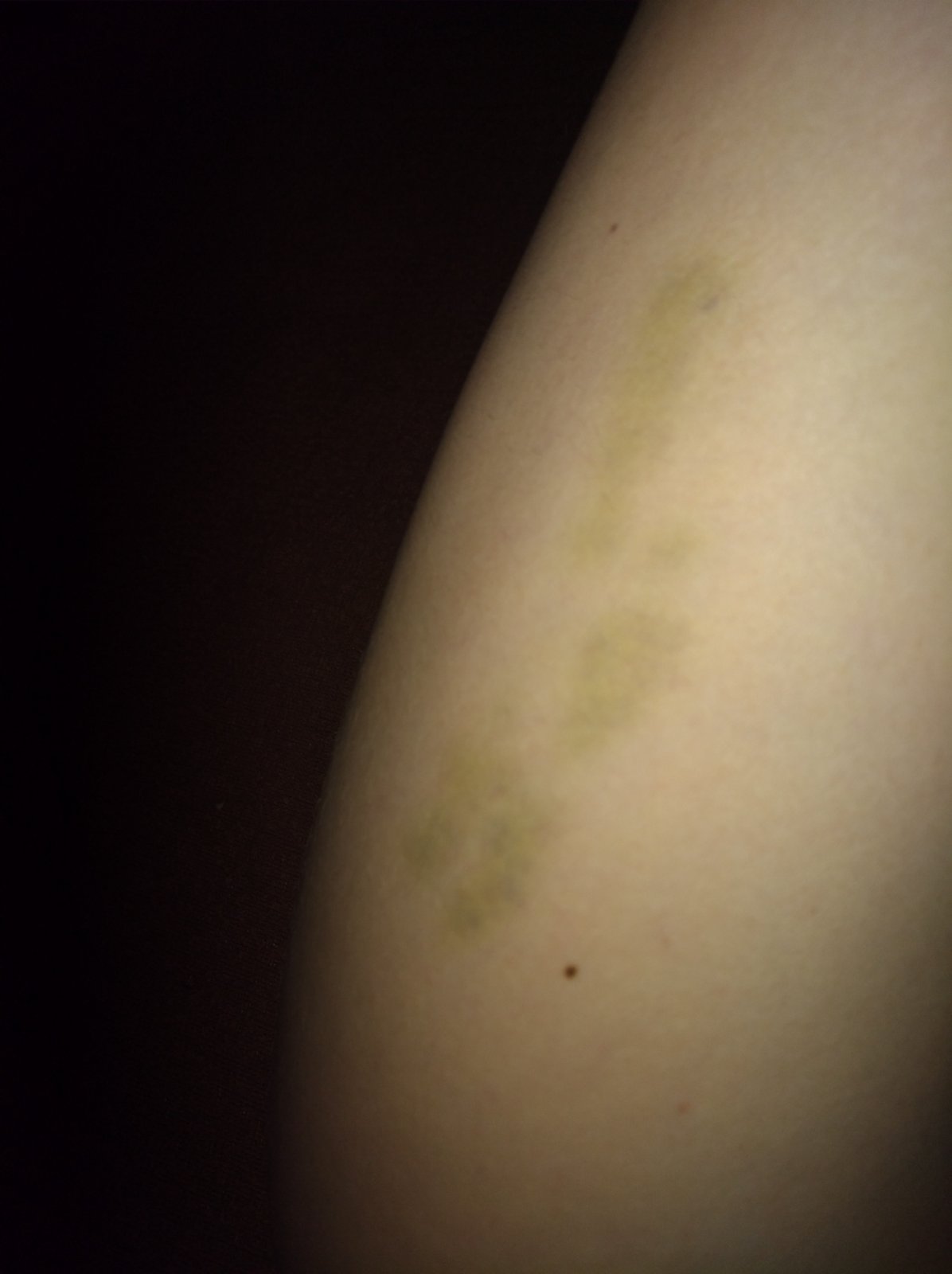 Modriny na nohách bez buchnutia - Modrý koník