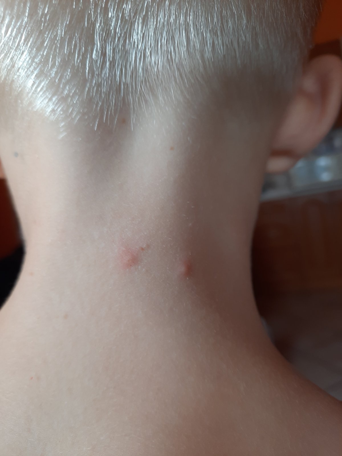 Sú tieto červené vyrážky kiahne? - Modrý koník