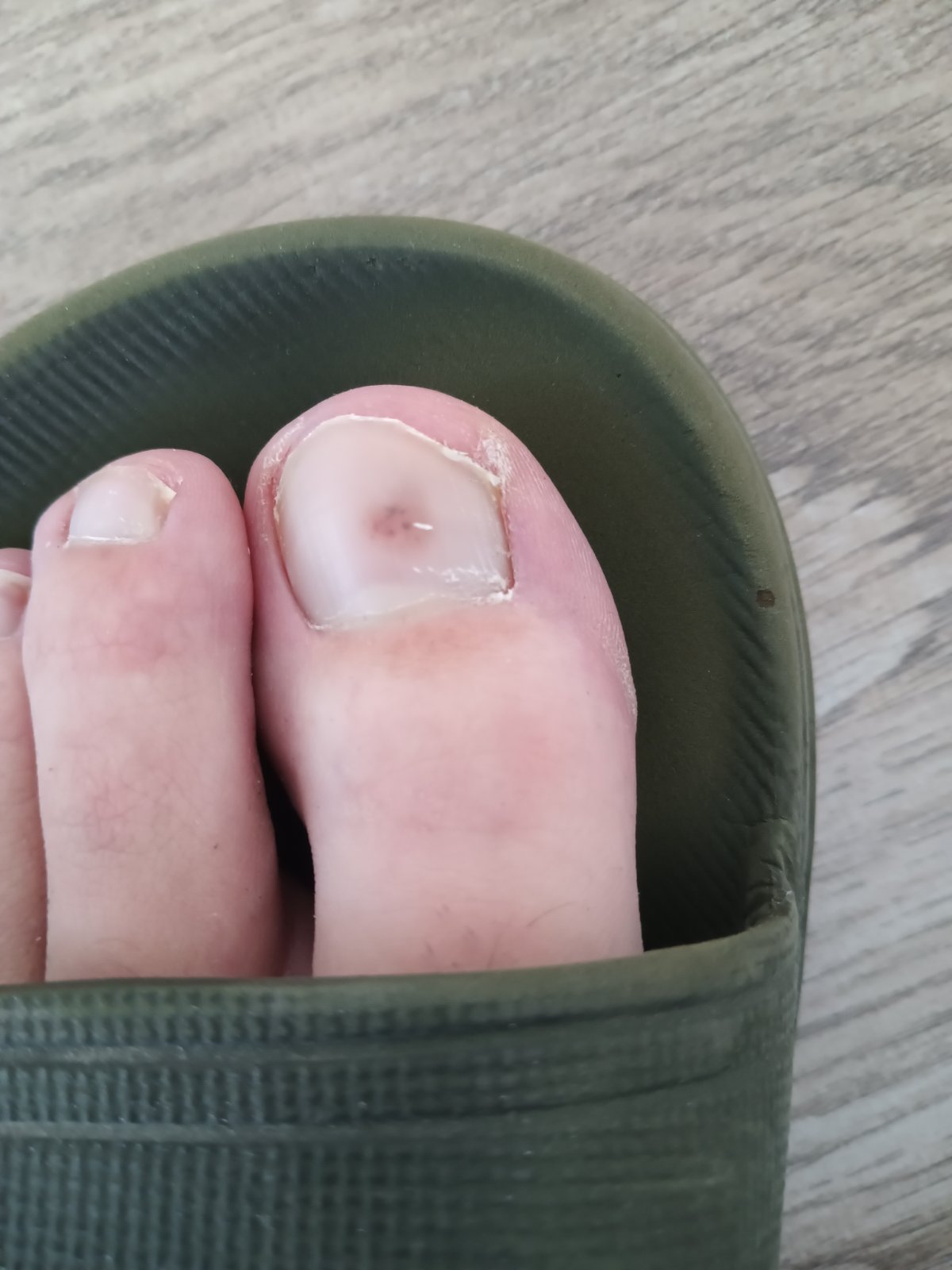 Neznámy problém na nechte po odstránení kurieho oka - Modrý koník