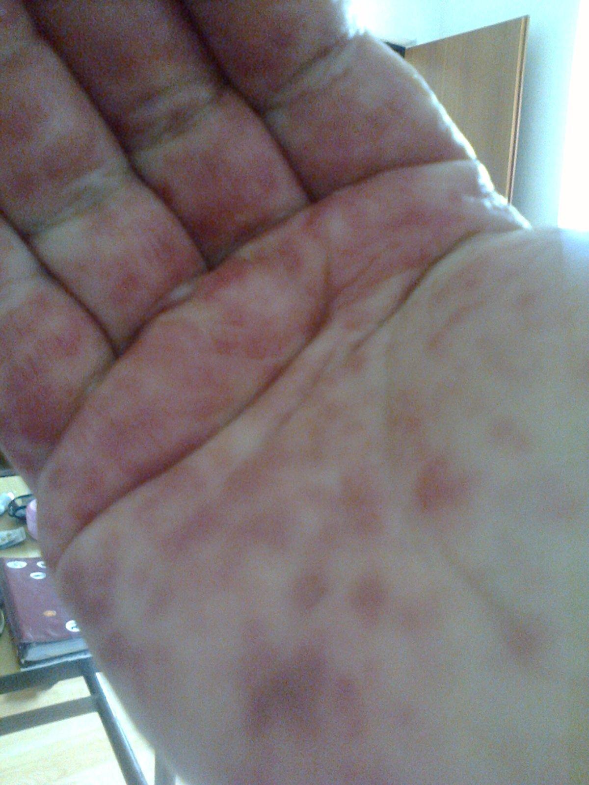 Coxiackie vírus - ruky, nohy a ústa - str. 4 - Modrý koník