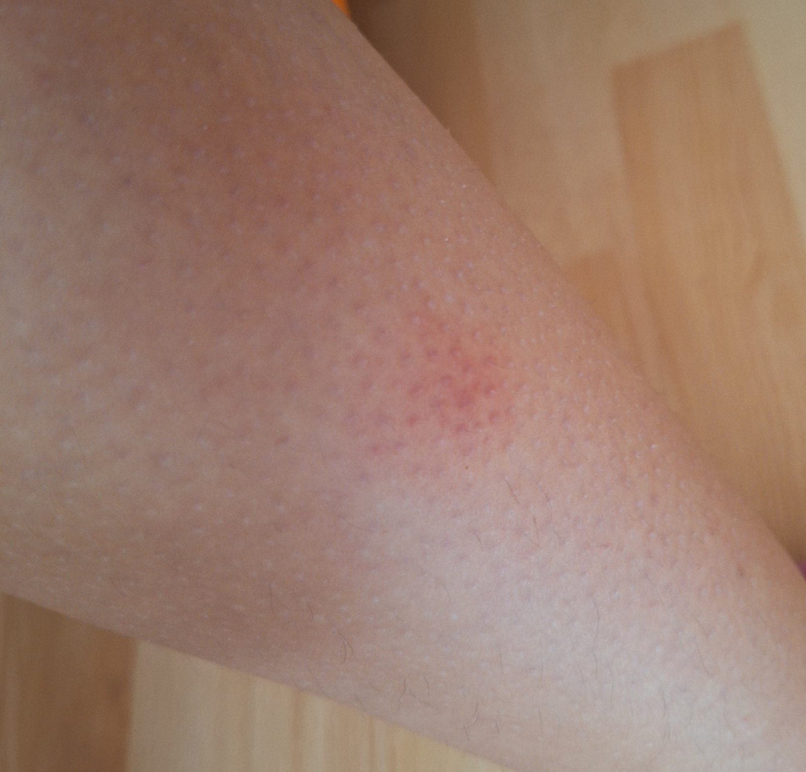 Štípance od komára - Modrý koník