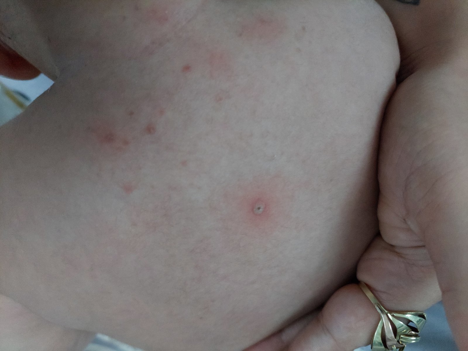 Vyrážky u 4-mesačného - Modrý koník