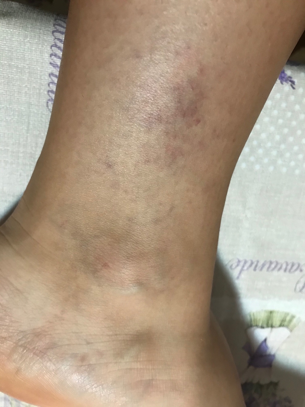 Tmavá nemiznúca modrina plus fialový fľak na nohe v 3. trimestri ...