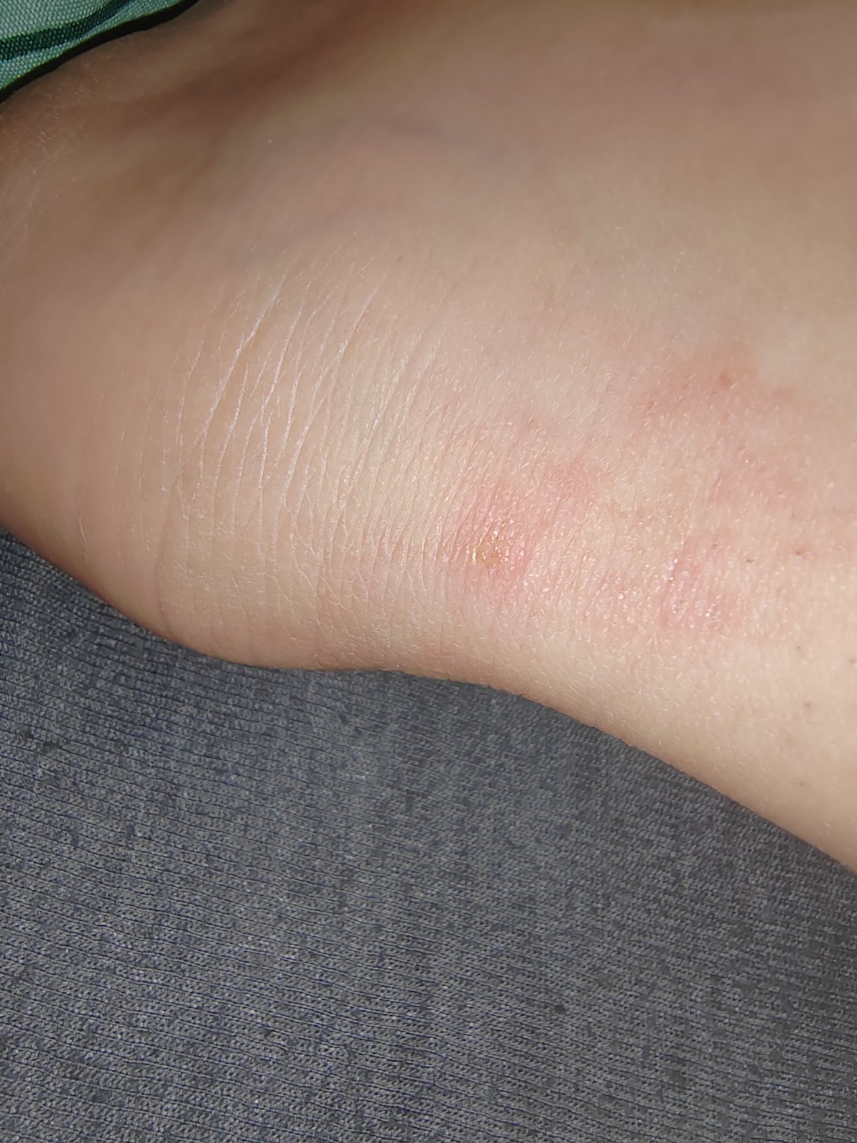 Sú to štípance od ploštice? - Modrý koník