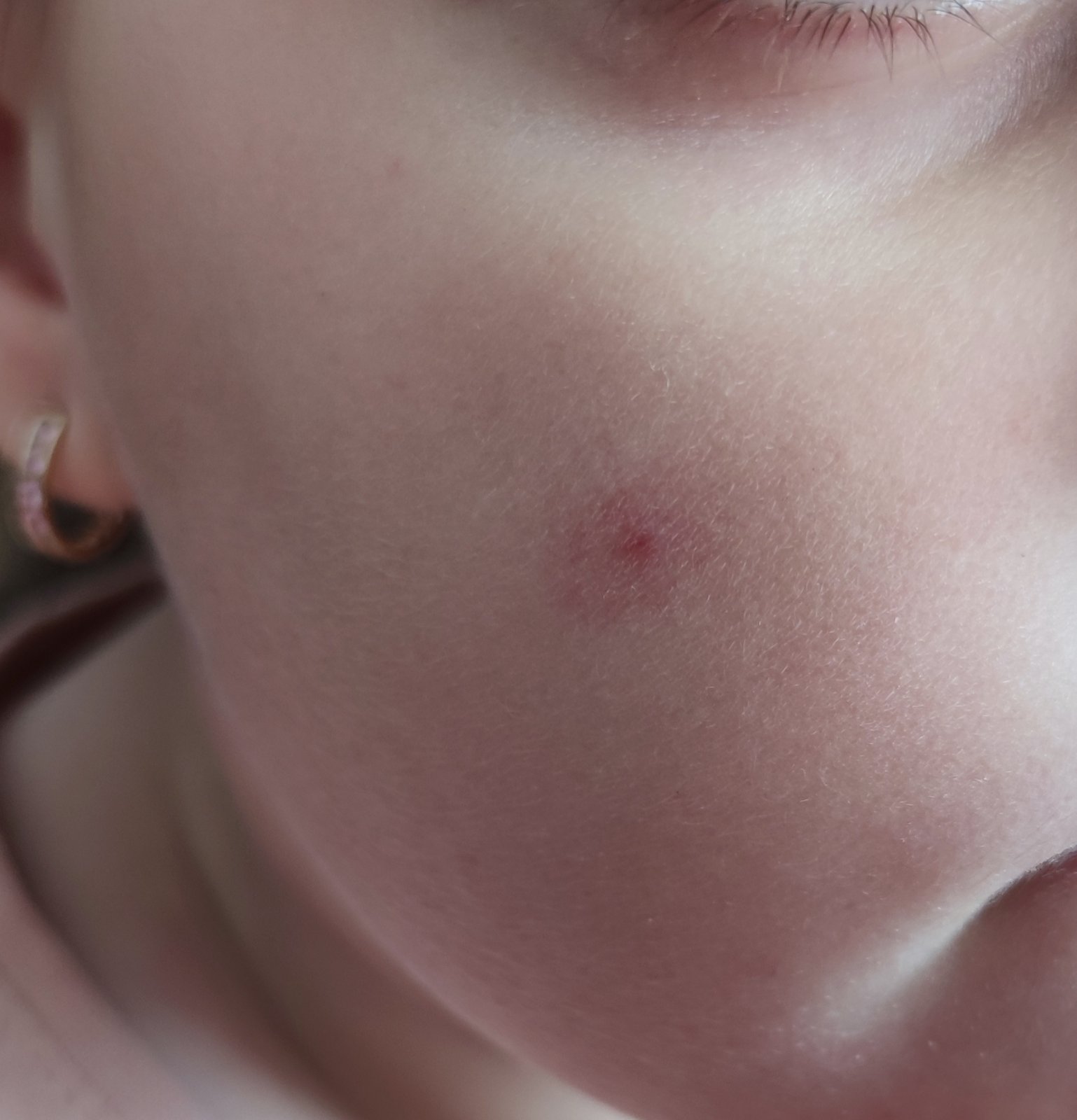 Čo môže znamenať fľak na líci dieťaťa? - Modrý koník