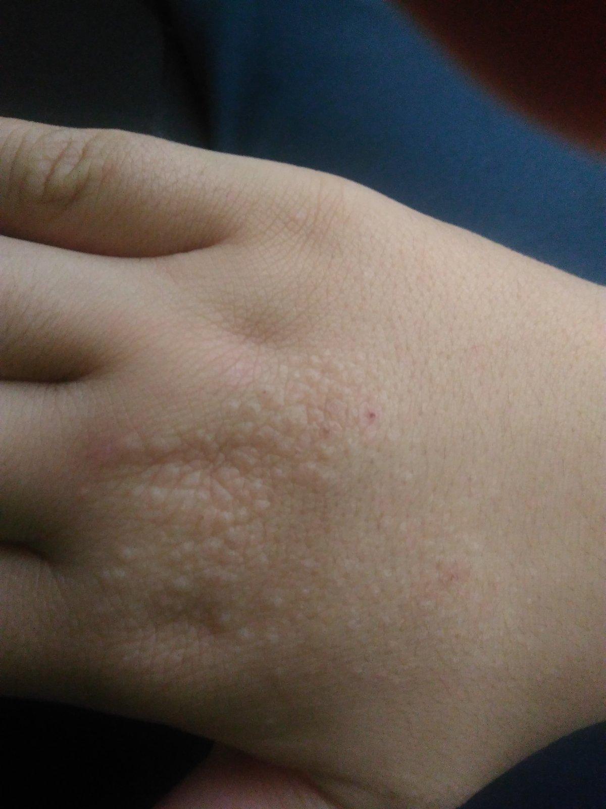 Vyrážky na ruke - Modrý koník