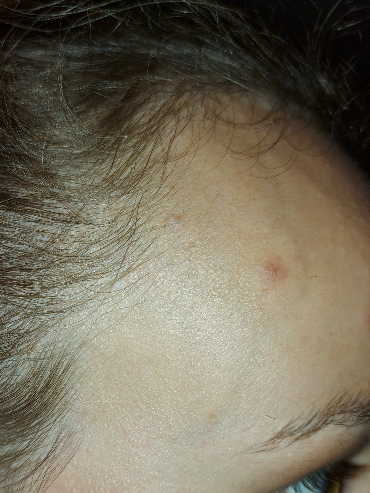 [Zodpovedané] Môže mi žila na čele spôsobiť nejaký problém? - Modrý koník