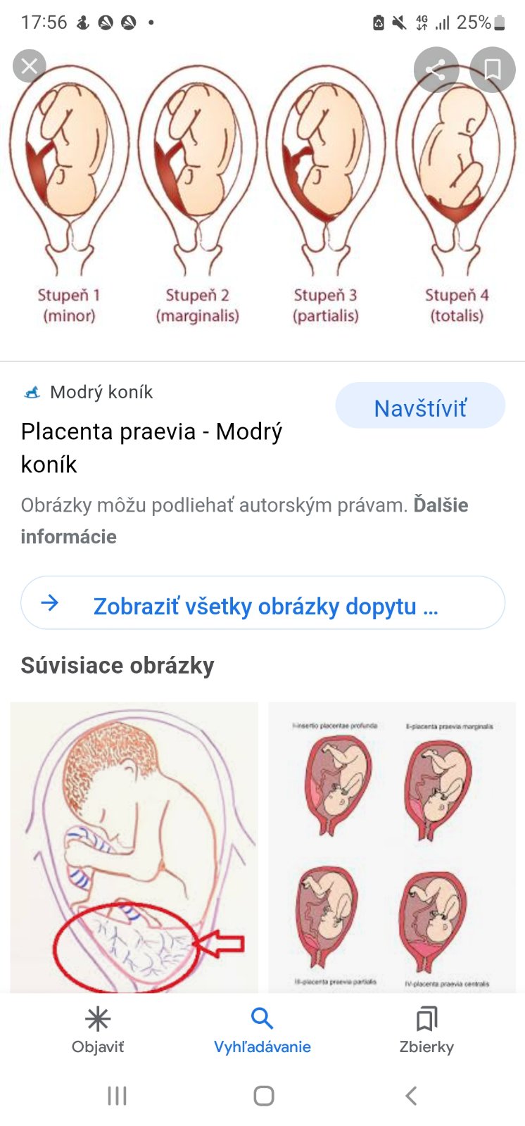 Placenta marginalis - zasahovanie do pôrodných ciest - Modrý koník