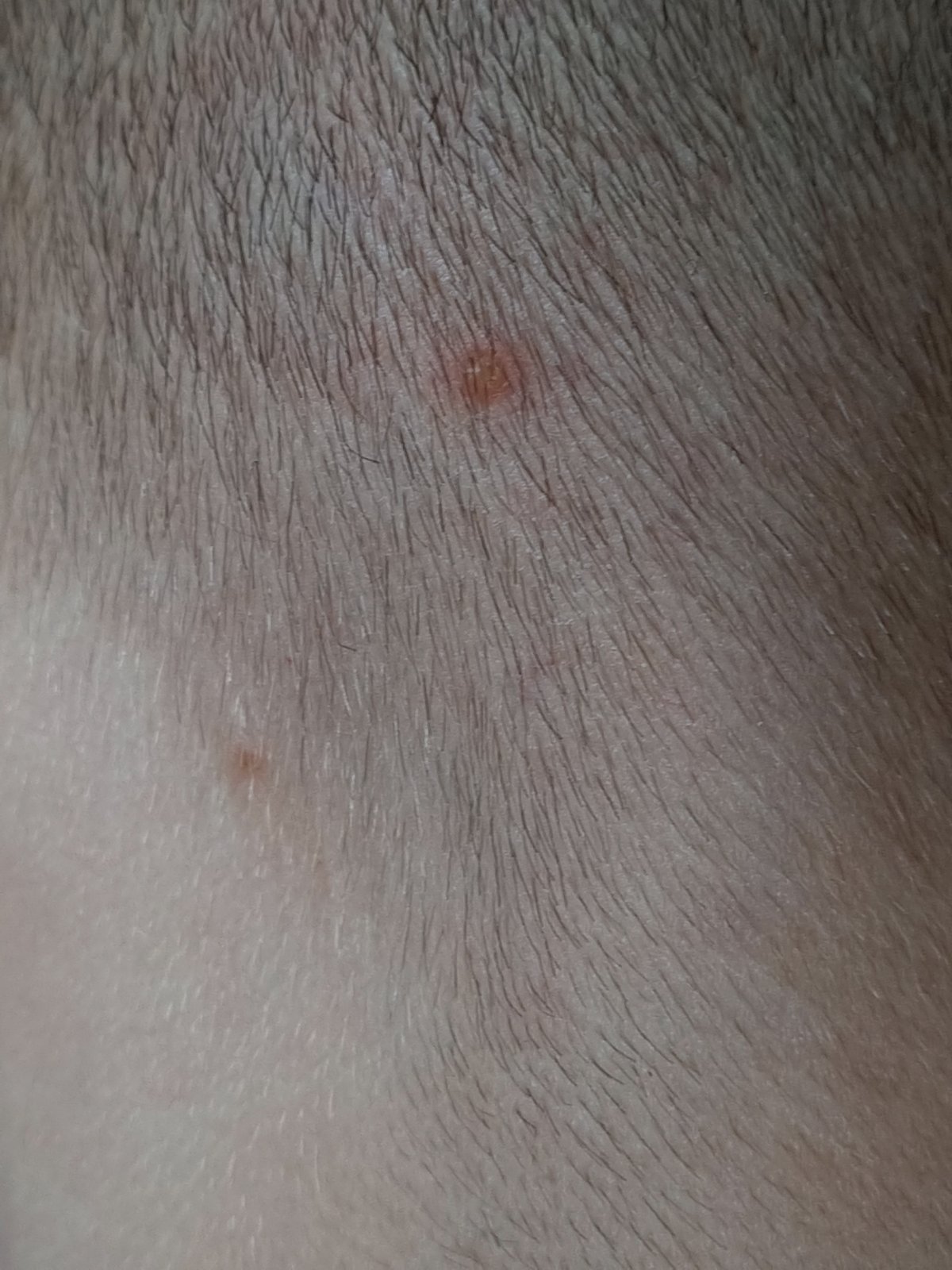 Môžu byť toto ovčie kiahne? - Modrý koník