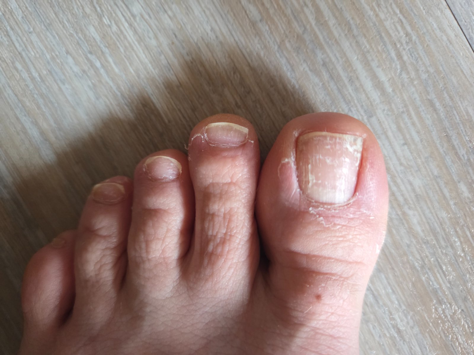 Riešenie problémov s nechtami - Modrý koník